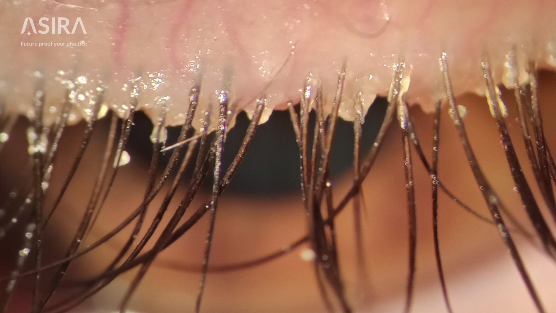 Understanding Demodex Blepharitis: A Comprehensive Review